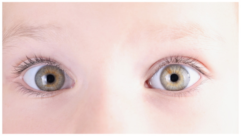 Squint in Children: Causes, Treatments, and Long-Term Care